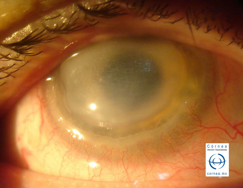 melting-corneal-en-paciente-con-artritis-reumatoide | Córnea ...