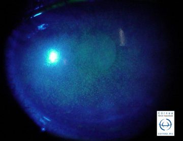 queratitis-punteada-superficial | Córnea - Trasplante de Córnea, LASIK ...